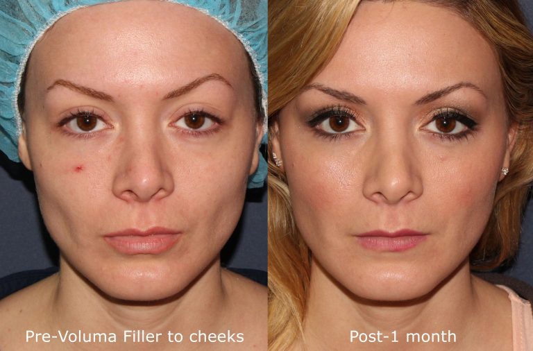 Voluma Fillers Abu Dhabi - Sydney Royal Aesthetics